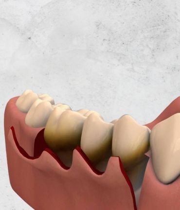 Gum Flap Surgery in Surat | Nxtdent Dental Clinic
